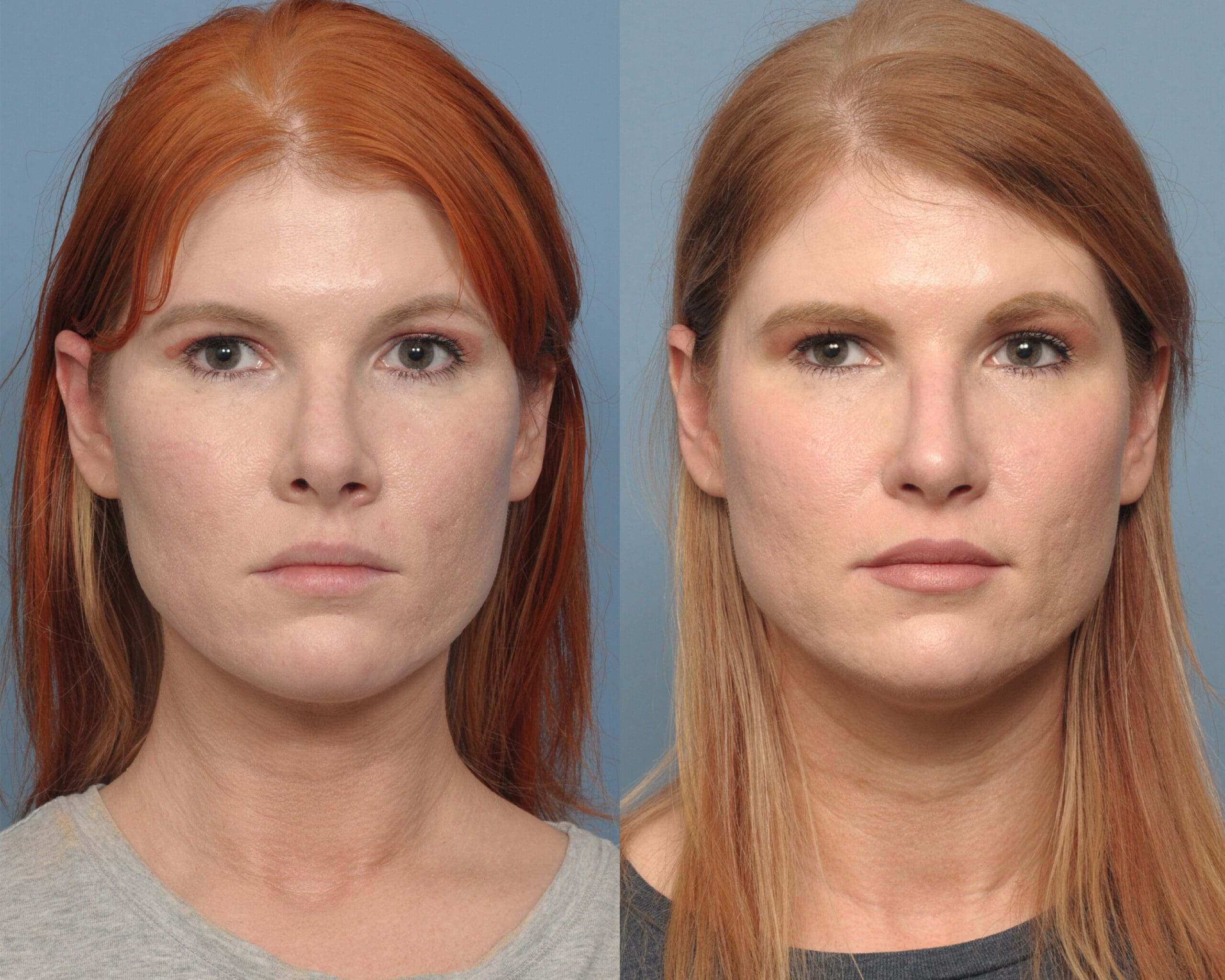 New York's Top Rhinoplasty Surgeon