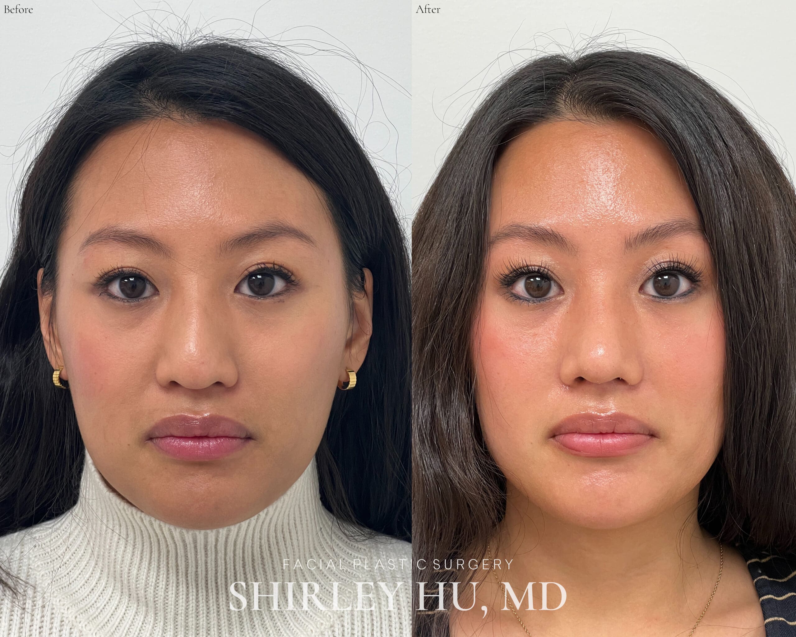 Dr. Hu - Rhinoplasty Landing Page - AIREM