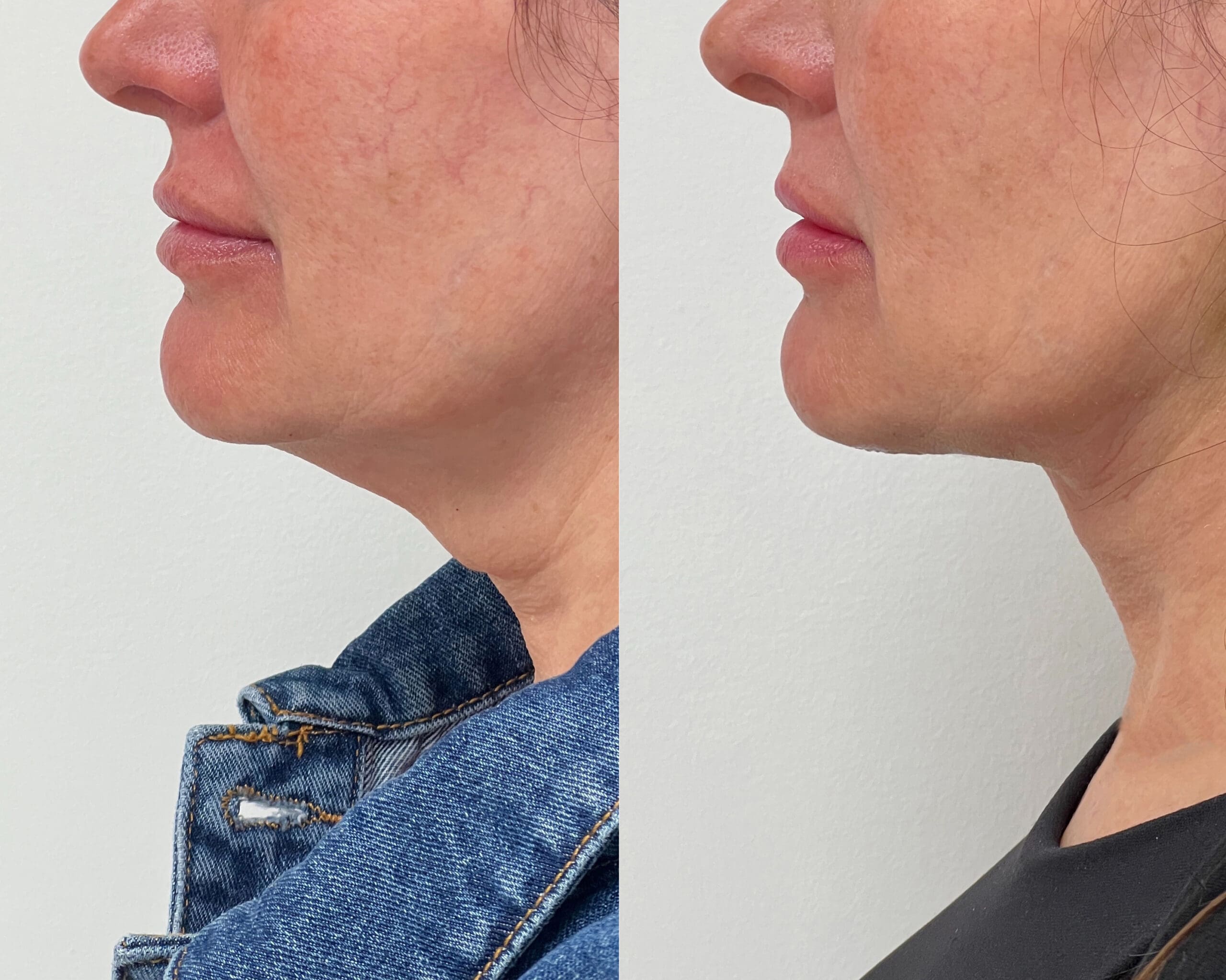 New York's Top Neck Lift Surgeon