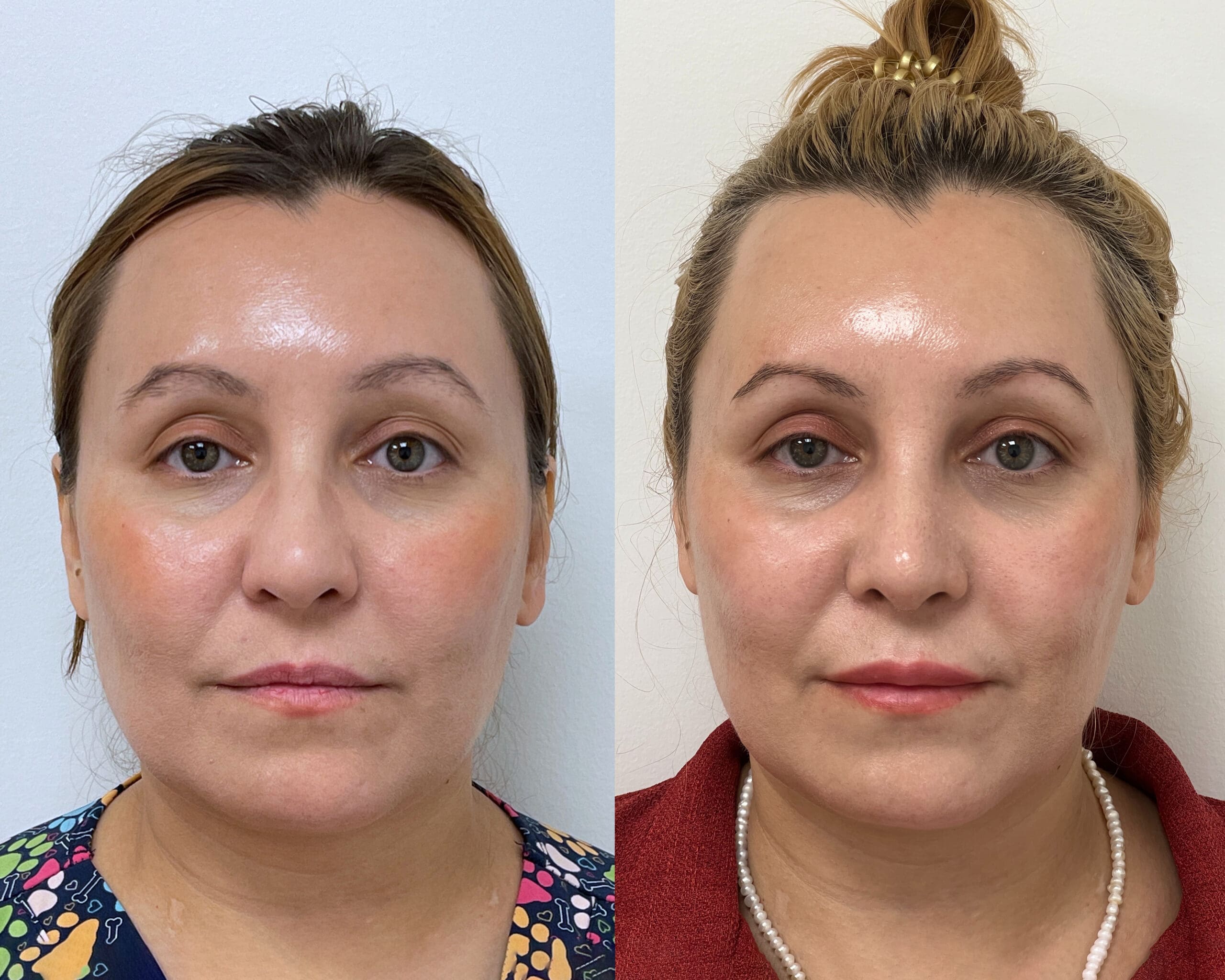 New York's Top Rhinoplasty Surgeon