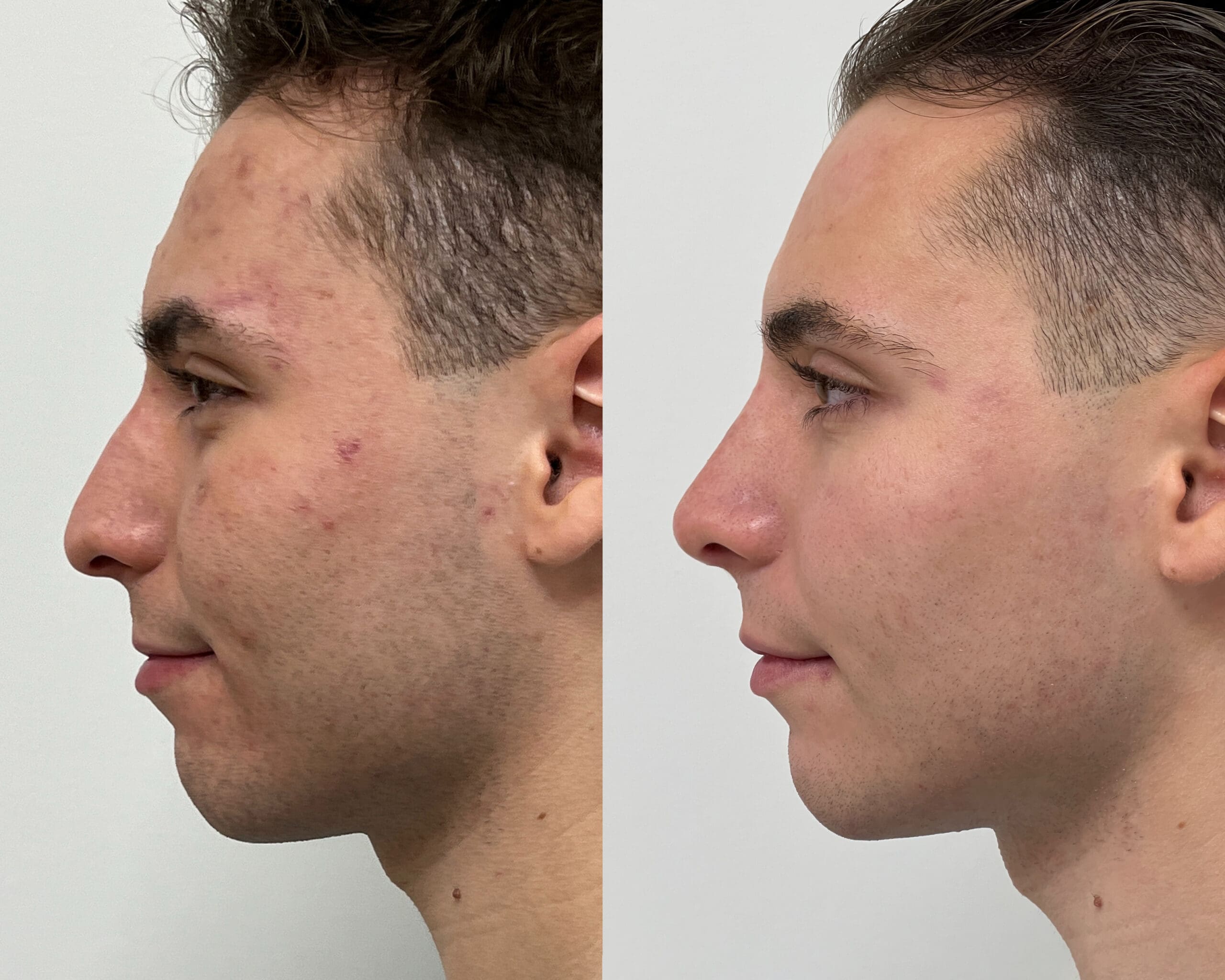 New York's Top Rhinoplasty Surgeon