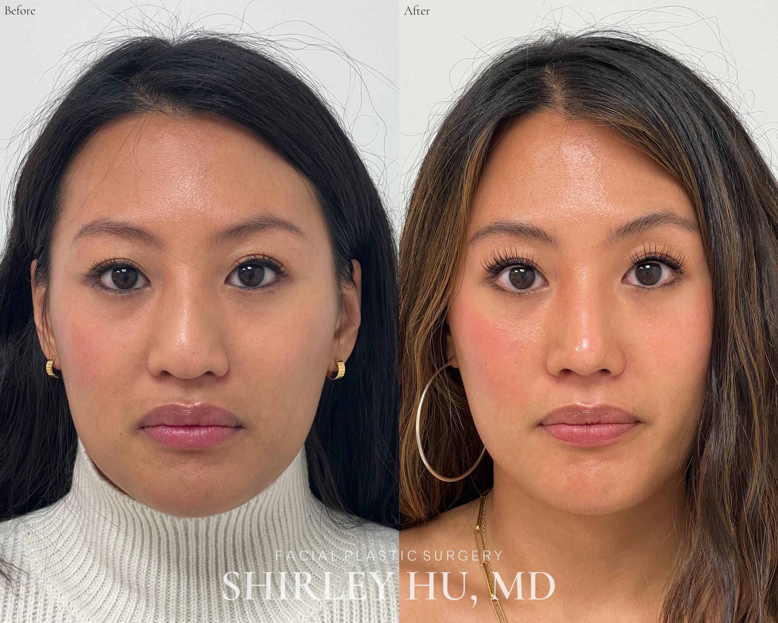New York's Top Rhinoplasty Surgeon