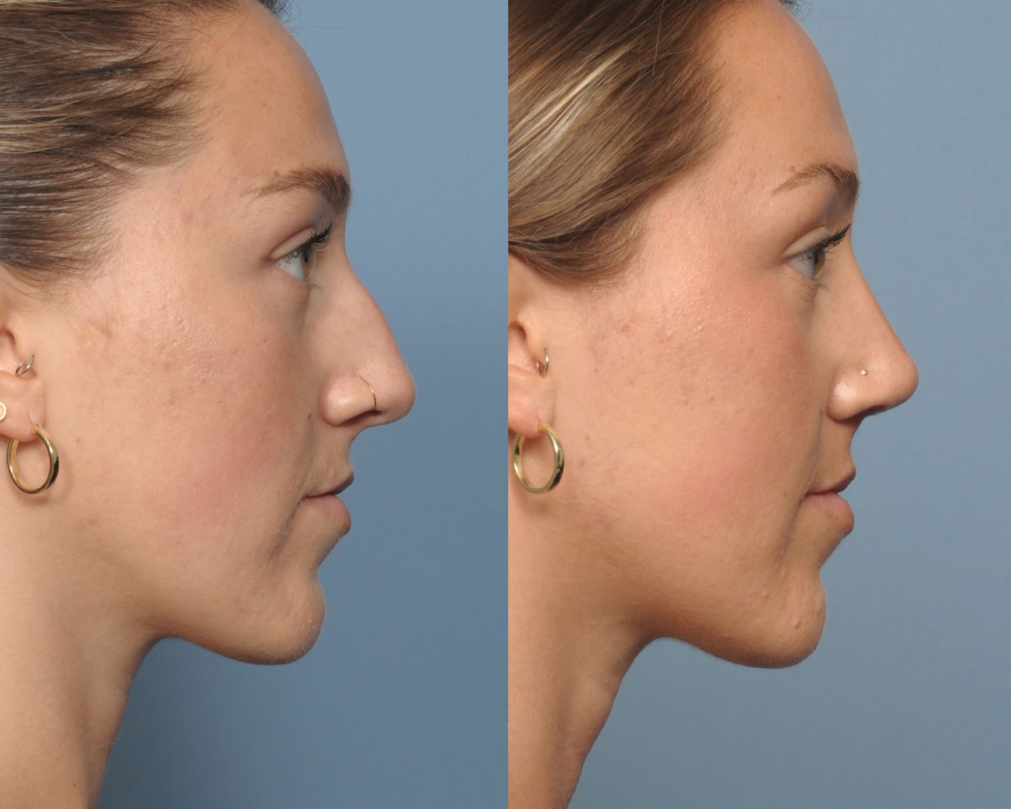 New York's Top Rhinoplasty Surgeon