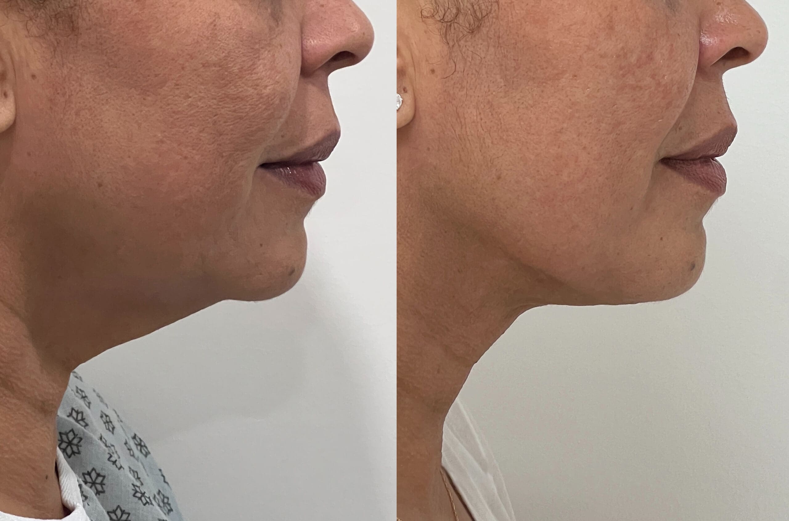 Neck Lift Surgeon | AIREM