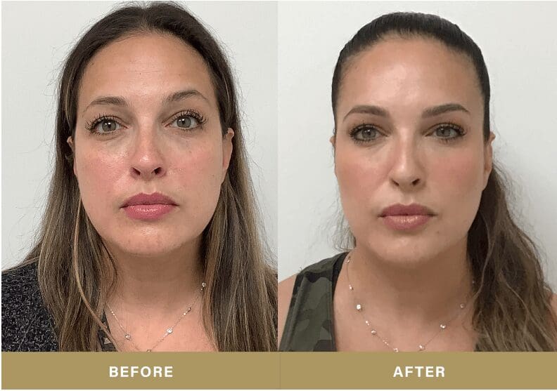 Dermasmooth Long Island, NY | Queens Dermasmooth